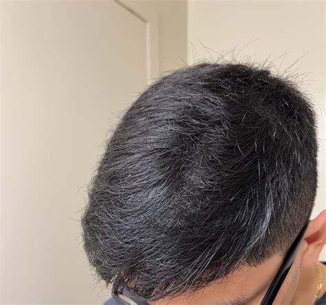 Could This Be Diffuse Alopecia Areata Mixed With Aga R Alopecia Areata