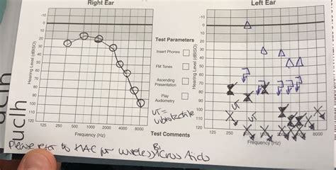 What Do The Triangle S Mean On This Photo Of My Audiogram Hearing
