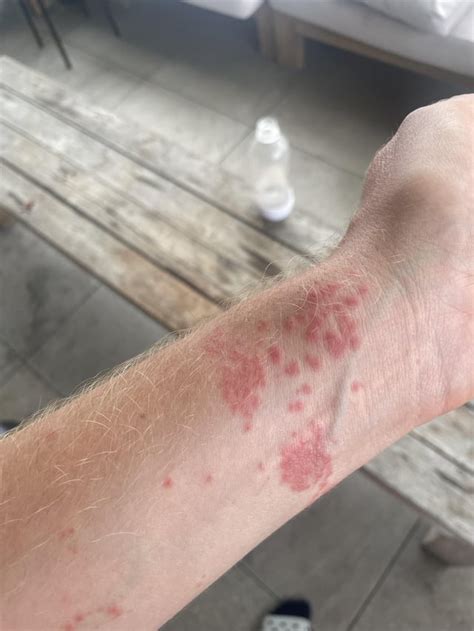 Whole Body Rash After Taking Doxycycline R Dermatologyquestions