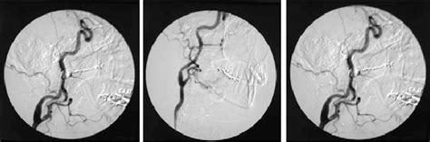 Embolization Of The Right Internal Maxillary Artery Download Scientific Diagram
