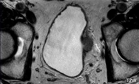 The Radiology Assistant Bladder Cancer Vi Rads