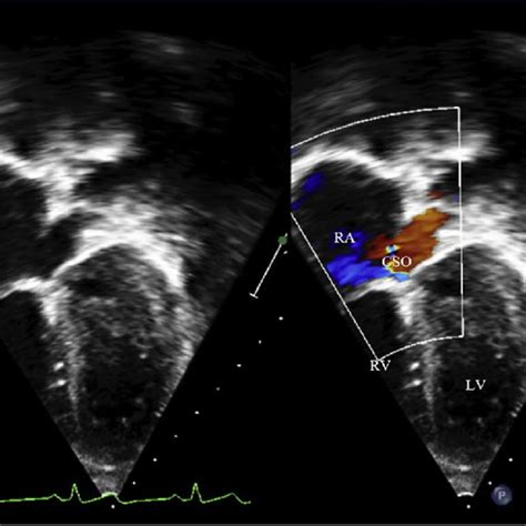 Subxiphoid Short Axis View On Transthoracic Echocardiogram Cso Cs