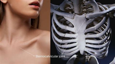 Sternoclavicular Joint Lump Treatment At Priscilla Carollo Blog