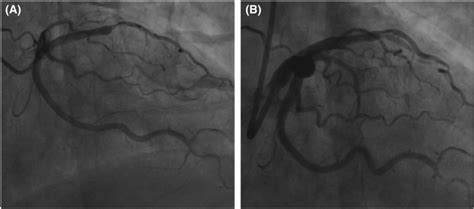 A Coronary Angiography Demonstrated A Subtotal Occlusion Of The Left Download Scientific