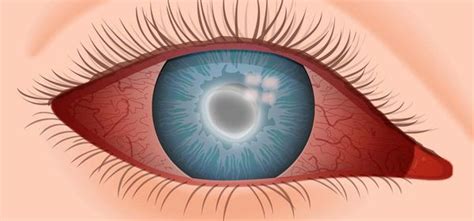 Конъюнктивит причины симптомы и лечение в статье офтальмолога хирурга Ахунов А А