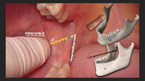 Navigating Wisdom Tooth Impactionpptx Dan Ppt