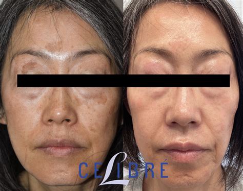 Sun Spot Laser Treatment Cost Procedure Results And Before And After