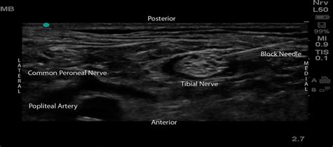 Anesthesia Analgesia