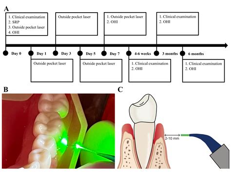 Diode Laser Non Surgical Periodontal Therapy At Jett Tishler Blog