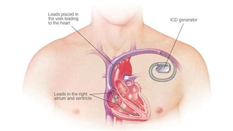 Automatic Implantable Cardioverter Defibrillator In India Rawa H