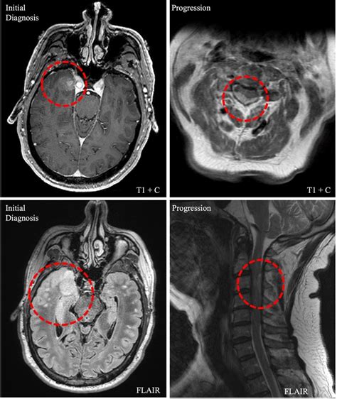 Mri Of The Cns Axis From Case 4 Left Mri Of The Brain With And