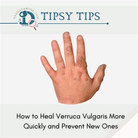 Tipsy Tips How To Heal Verruca Vulgaris — Dermapamine By Dermapamine Club