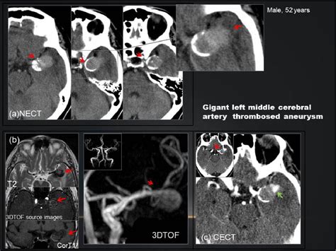 Figure 14 From Computed Tomography Patterns Of Intracranial Calcifications Always Easy To
