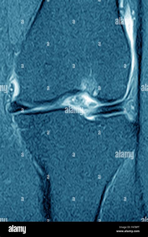 OSSEOUS EDEMA MRI Stock Photo Alamy