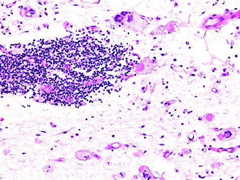 Focal Formation Of Lymphoid Aggregates Composed Of Lymphocytes At The Download Scientific