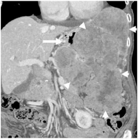 A Year Old Man With Malignant GIST Coronal Contrast Enhanced CT Download Scientific Diagram