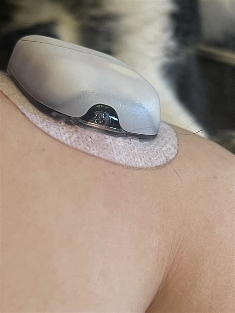 Omnipod 5 Is Continuously Leaking Humalog Rtype1diabetes