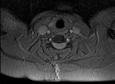 Right Lobe Thyroideal Solitary Nodule The Nodule Is Slightly