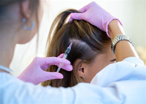 Scalp Cortisone Shot Brentwood Hair Loss Downtown Los Angeles