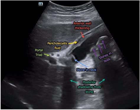 Gallbladder Ultrasound Cholecystitis