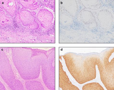 High Risk Hpv Ish In Buschke Löwenstein Tumor Blt With Invasive