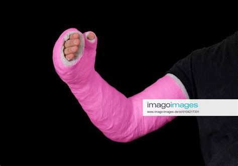 Pink Elbow Cast