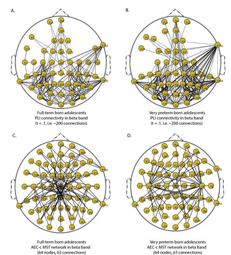 Eishi Asano On Linkedin [eeg Connectivity] Van T Westende Et Al Very Preterm Born Adolescents…