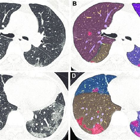 Chest Ct Images In A 66 Year Old Woman With The Delta Variant Of