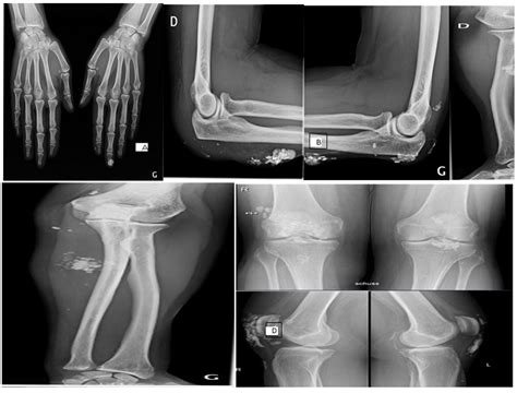 Calcinosis Scleroderma
