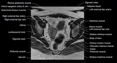 Female Pelvis Anatomy Free Axial Cross Sectional Anatomy Of Female Pelvis