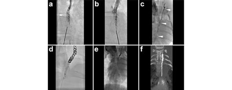 Illustration Of Tde Using Coils And Sequential Nbca Lipiodol Mixture Download Scientific