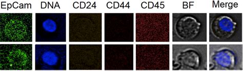 Two Examples Of Circulating Epithelial Cells Detected In Post Surgery