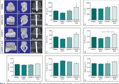 Figure 1 From Vertical Bone Augmentation Using Deproteinized Bovine Bone Mineral Absorbable