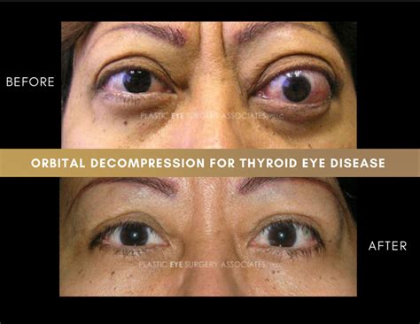 Hyperthyroidism Eyes Before And After
