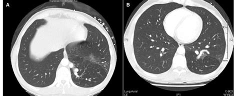 A B Ct Scan Showing Aberrant Formation Of Segmental Lung Tissue Within