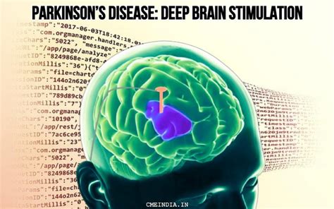 Parkinsons Disease Deep Brain Stimulation When Needed Cme India