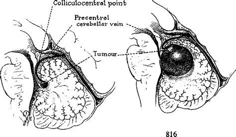 Precentral Cerebellar Vein Semantic Scholar