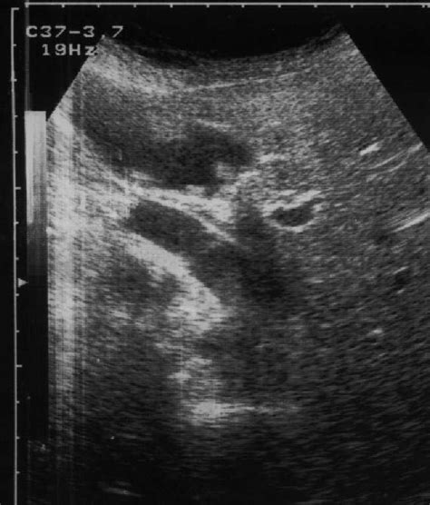 Three Small Gallbladder Polyps Measur Ing About 6mm And One Of A