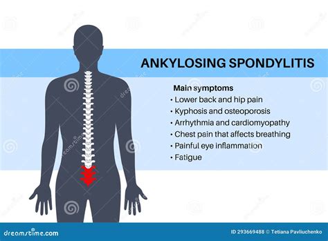 Ankylosing Spondylitis Disease Vector Illustration