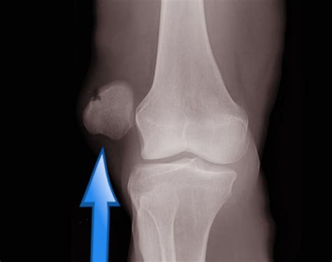 Patella Dislocation Knee Dislocation Md Searchlight