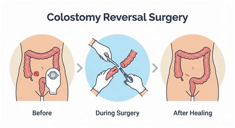Colostomy Reversal Surgery What To Expect Before During And After The Procedure