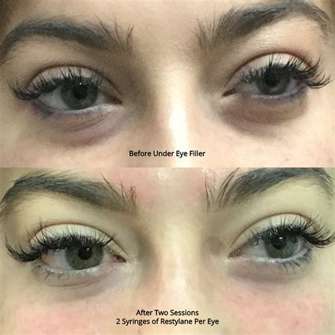 Tips For Getting A V Shaped Or V Line Face Naturally Without Surgery Or Injections Usha