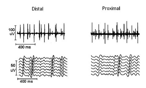 Example Of 400 Ms Long Epochs Of Intramuscular Emg Signals And Related