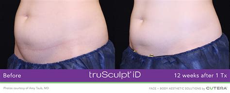 Trusculpt Id Amy Taub Md 3 Allure Clinic
