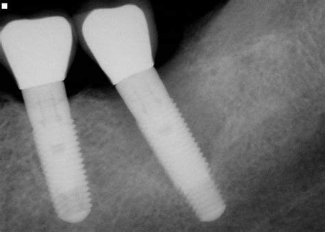 Causes Of Implant Failure And When To Replace La Dental Clinic