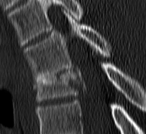 T5 Fracture