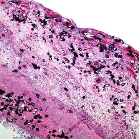 Ct Scan Showing Perforated Appendix With Extraluminal Contrast In The Download Scientific