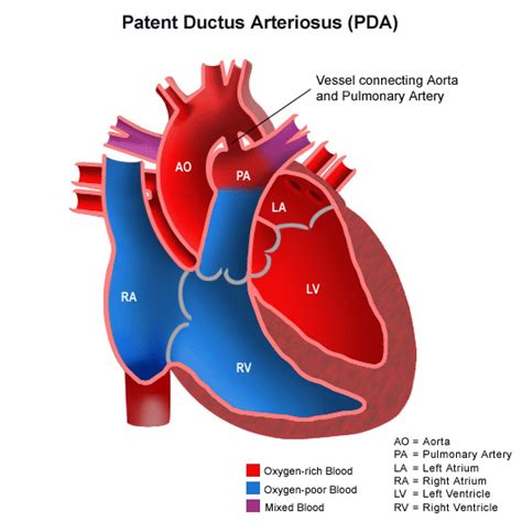 Congenital Heart Disease Symptoms And Causes Newyork Presbyterian