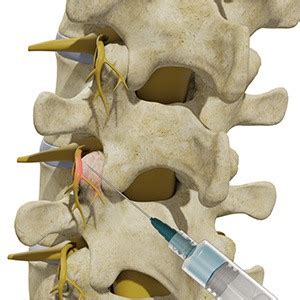 Facet Injection Procedure Chesterfield Mo Facet Joint Pain Treatment
