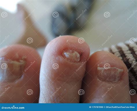Onychomycosis Or Fungal Nail Infection On Damaged Nails After Gel